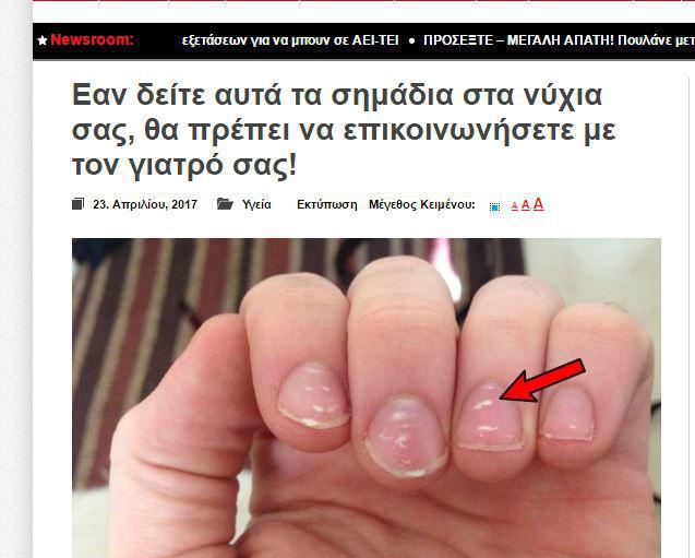 Εαν δείτε αυτά τα σημάδια στα νύχια σας, θα πρέπει να επικοινωνήσετε με ...